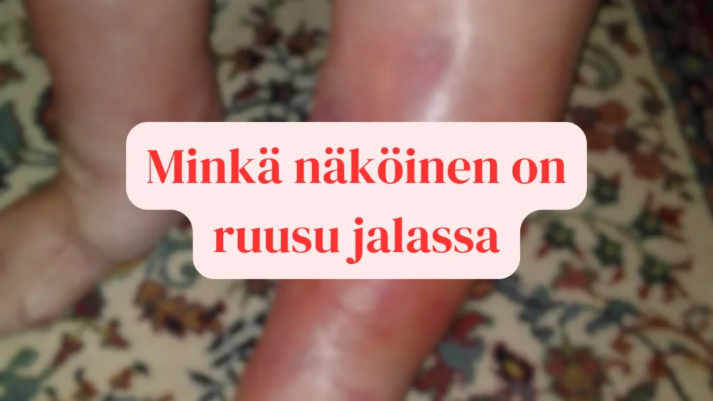 Minkä näköinen on ruusu jalassa?