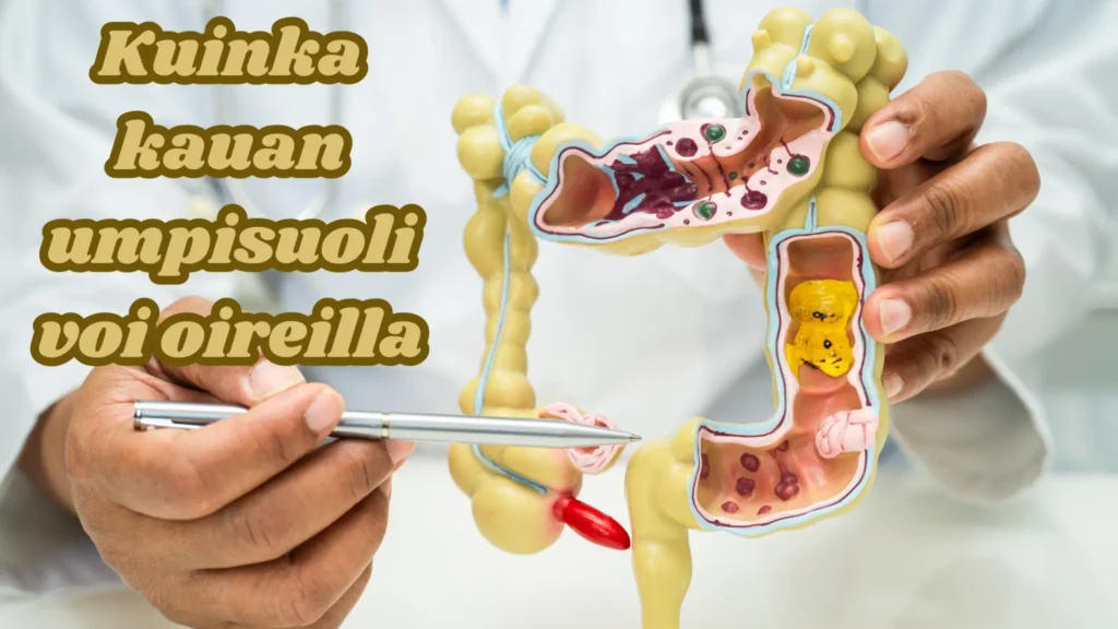 Kuinka Kauan Umpisuoli Voi Oireilla – Tärkeät Tiedot